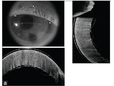 Keratoconus- Causes, Diagnosis & Treatment | Cornea Surgery